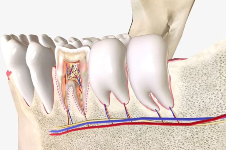 Root Canal Recovery Explained | Dentist Near You
